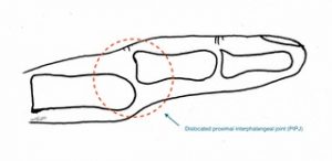 Bondi Junction Hand Therapy – Working hand in hand for a healthier you